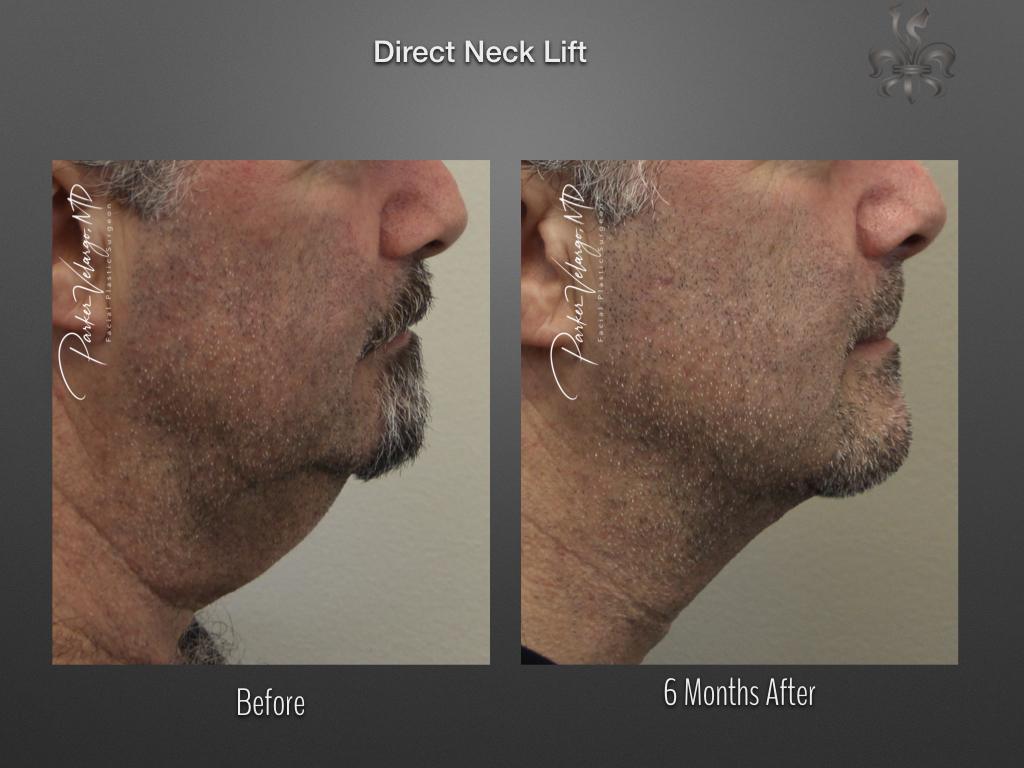 Direct Neck Lift New Orleans | New Orleans Center for Aesthetic ...