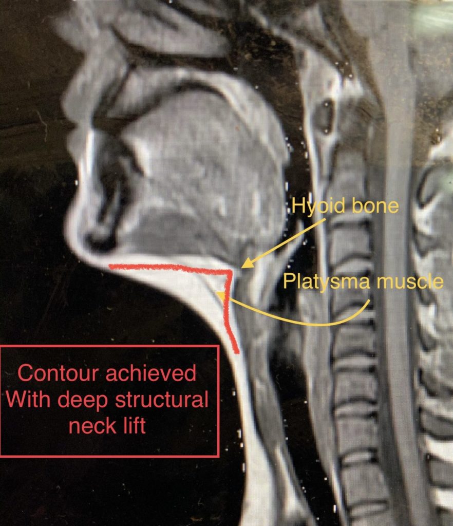 Deep Neck Lift | New Orleans, LA | Dr. Parker Velargo